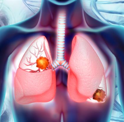 Lung Nodule Program | Healthcare Services in the Texas Midwest