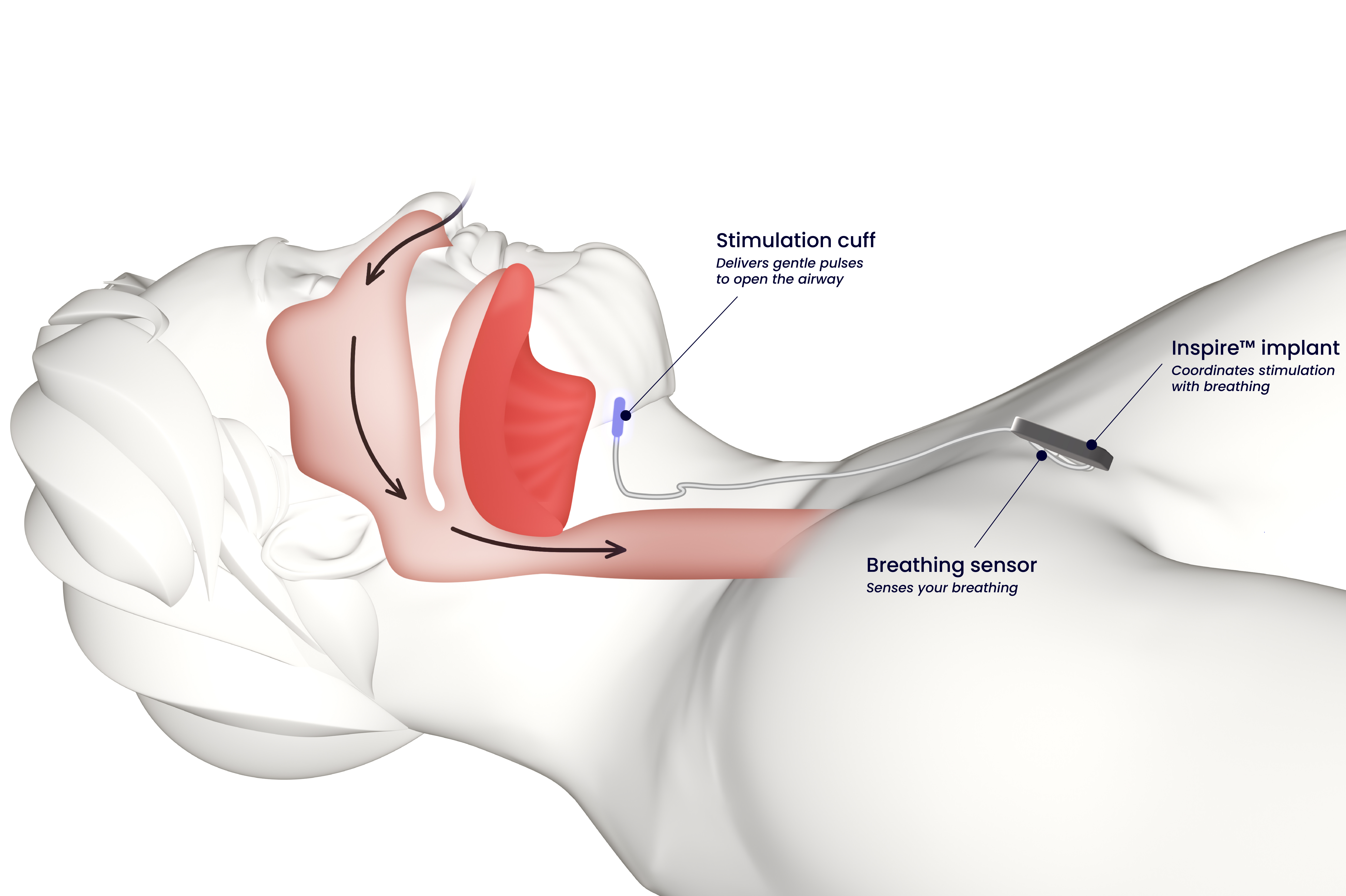 New obstructive sleep apnea treatment now available at Hendrick Health